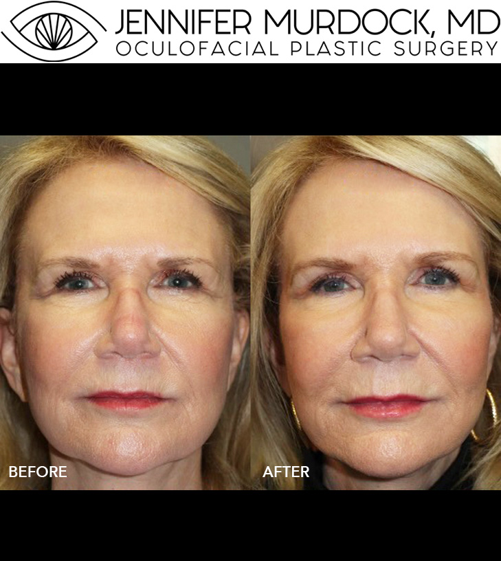 Before and After Photo Gallery | Jennifer Murdock MD